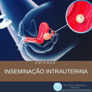Inseminação intrauterina | Dr. Silval Zabaglia